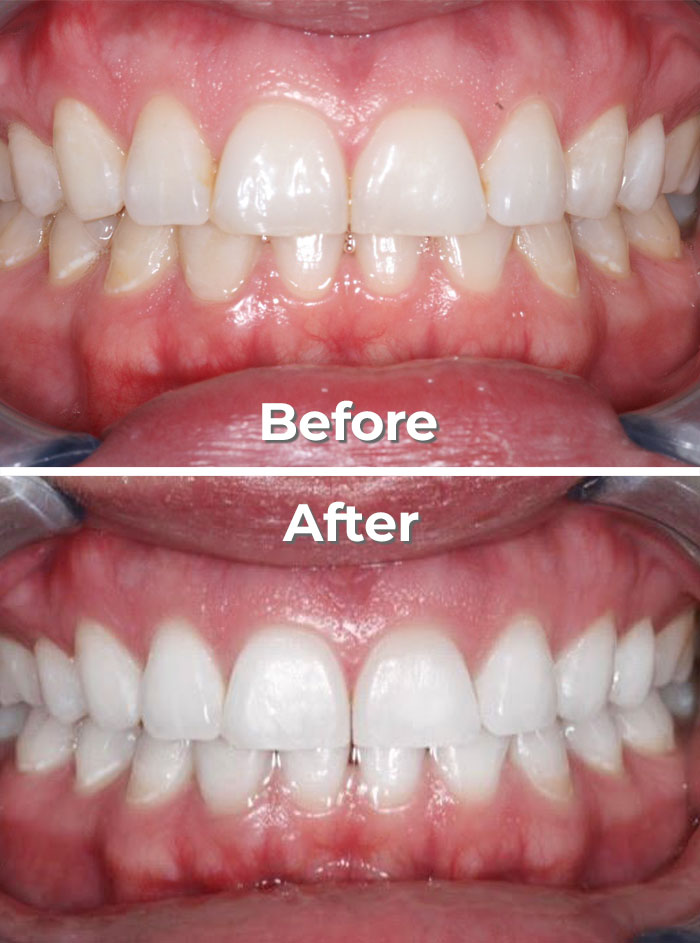 Smile Gallery – Premier Dental
